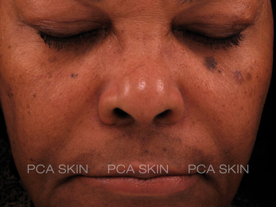 Before and After Professional Skin Care Products in Canada | PCA Skin ...